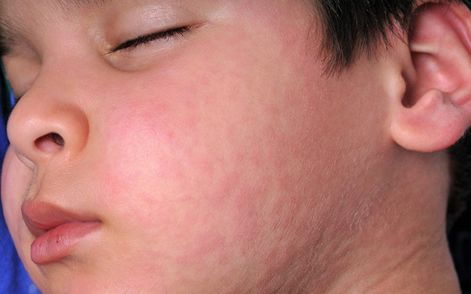 Urticária. Por que ela é tão frequente? | Brasil 247